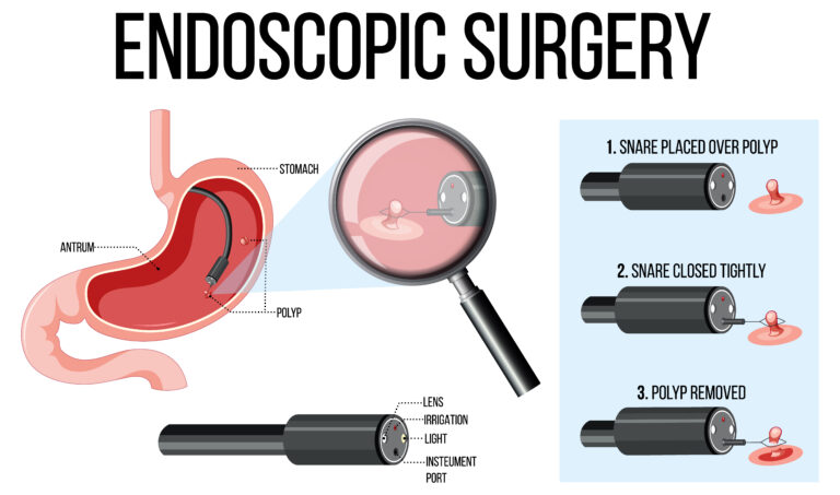 Endoscopy Demystified: What to Expect and How to Prepare - Nurture ...